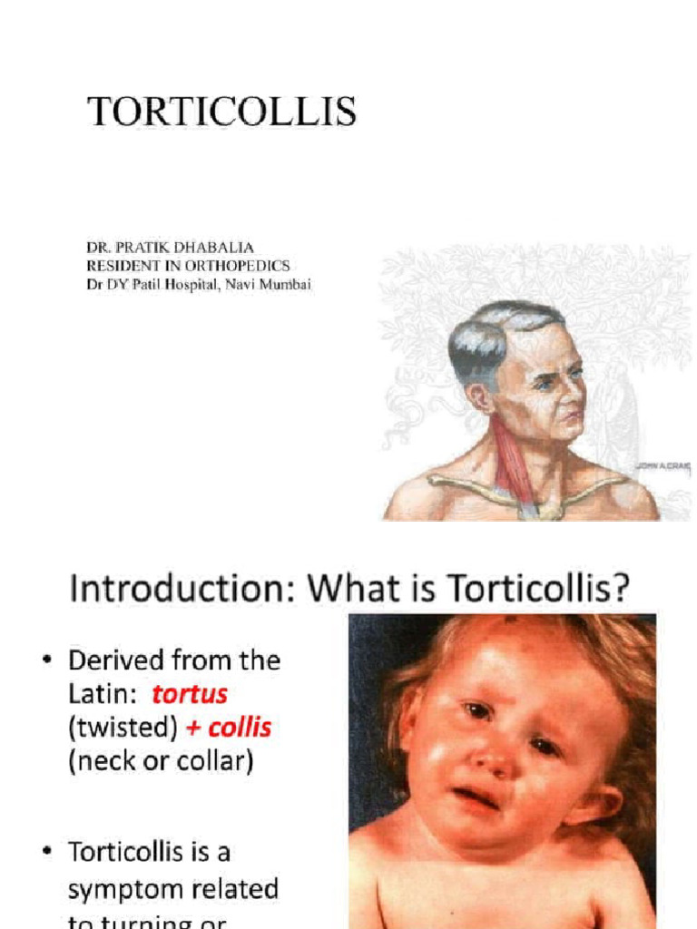 Torticollis - 20240603 - 230630 | PDF