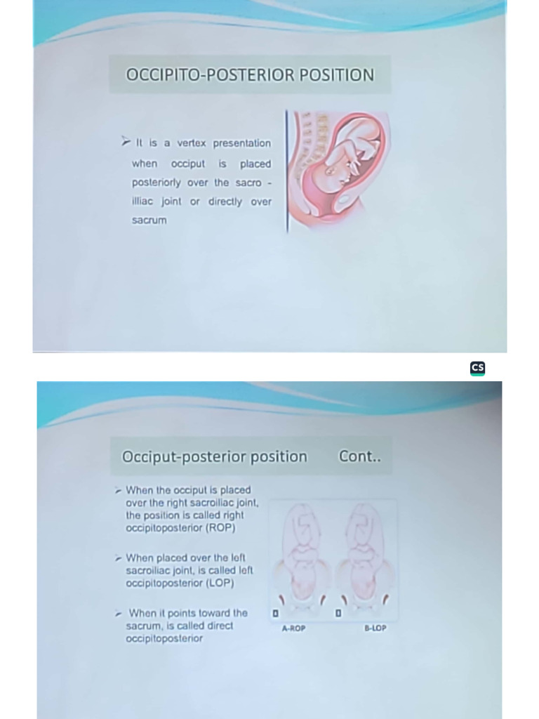 Occiput Posterior | PDF