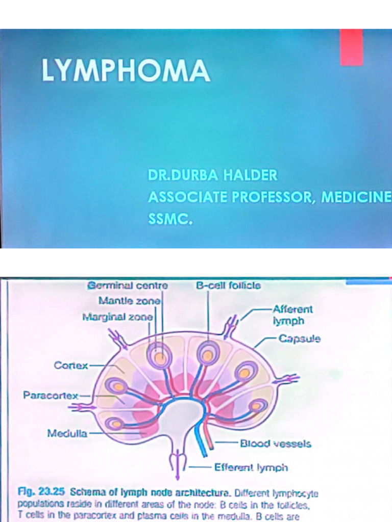 (New) Lymphoma | PDF