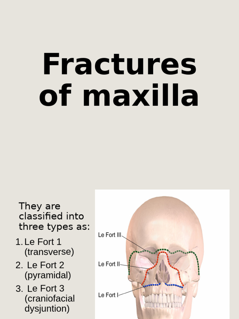 Maxilla and Mandible Fracture Types | PDF | Social Science | Foreign ...