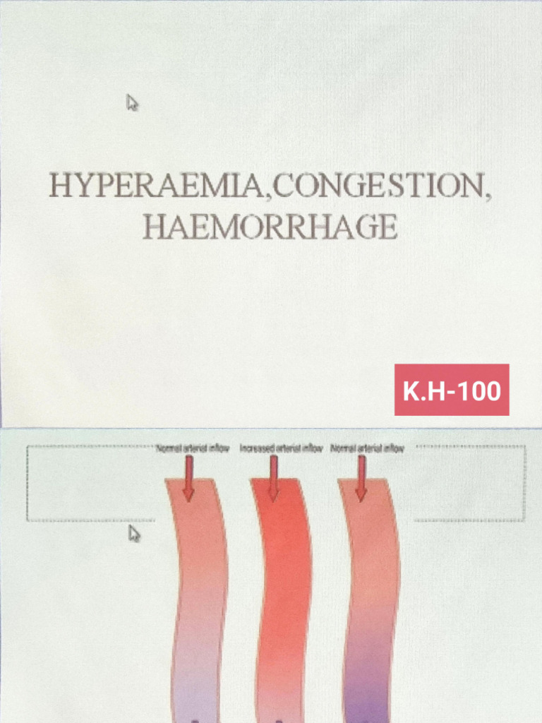 Hyperemia and Congestion - K.H 100 | PDF