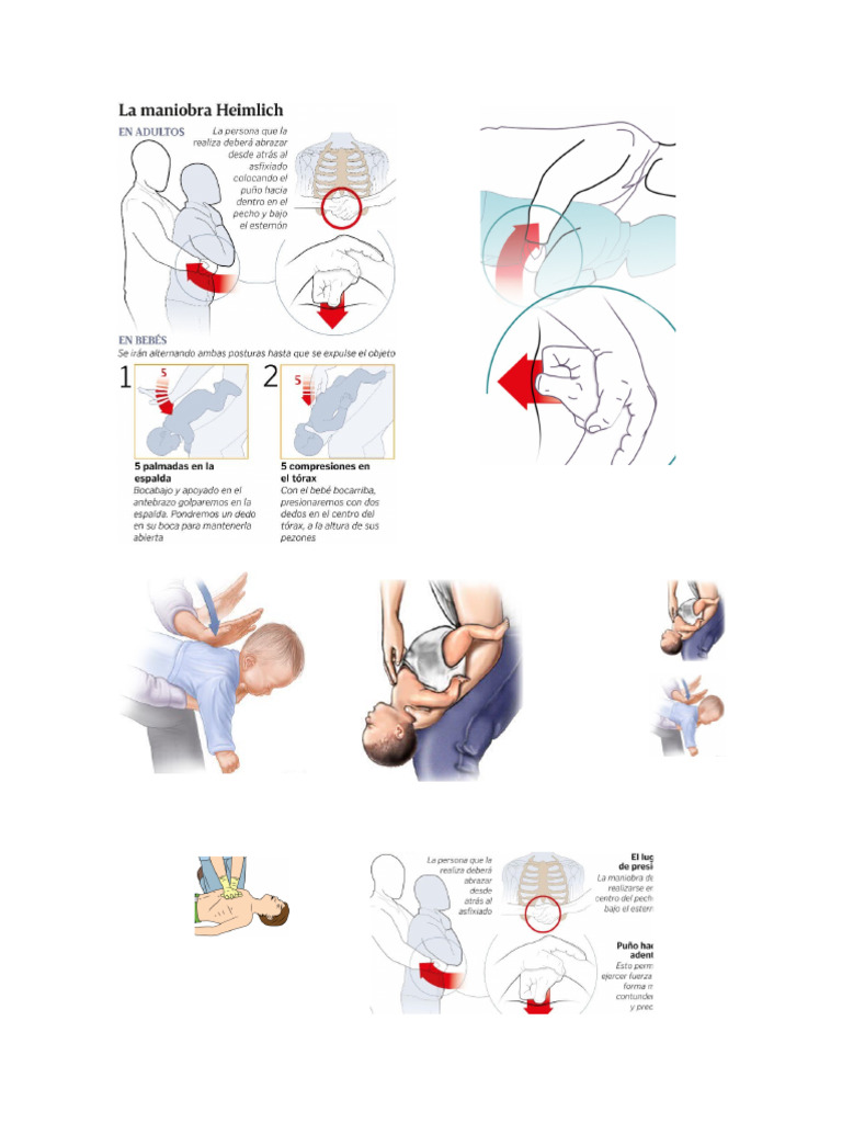 Maniobra de Heimlich | PDF