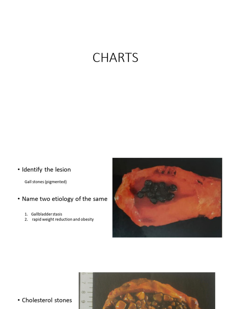 Presentation ulcer+stones | PDF