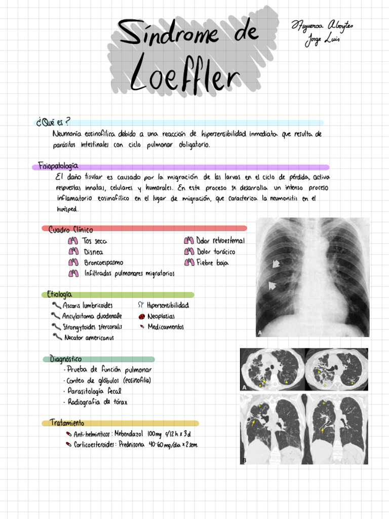 Síndrome de Loeffler - Jorge Figueroa | PDF