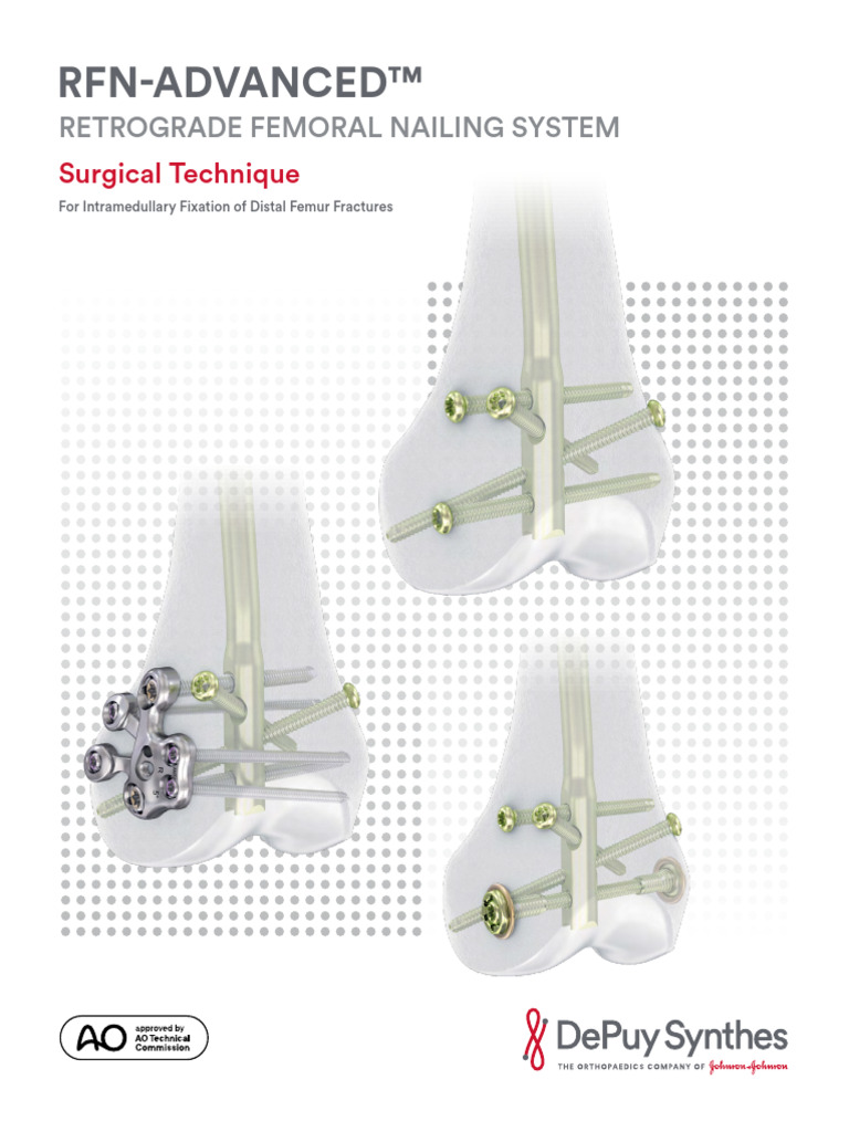 Surgical Technique Guide - RFN-ADVANCED Retrograde Femoral Nailing ...