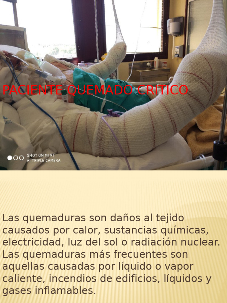 Paciente Quemado | PDF | Herida | Quemar
