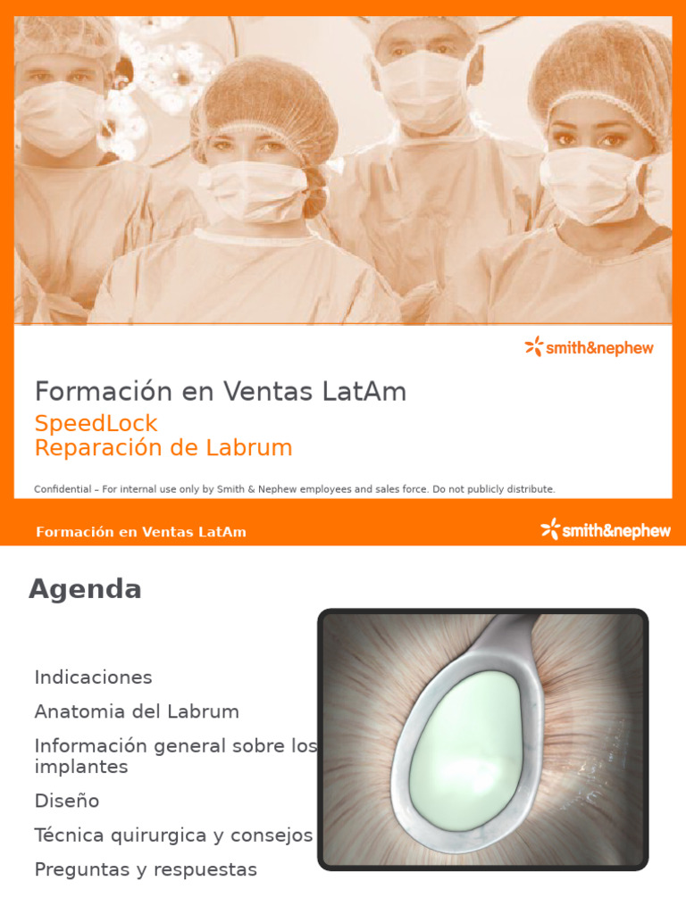 ASD - Spanish - Anatomia y Repación Del Labrum Con SPEEDLOCK | PDF