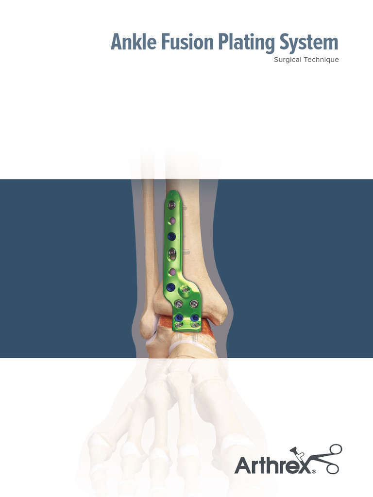Ankle Fusion Plating System | PDF