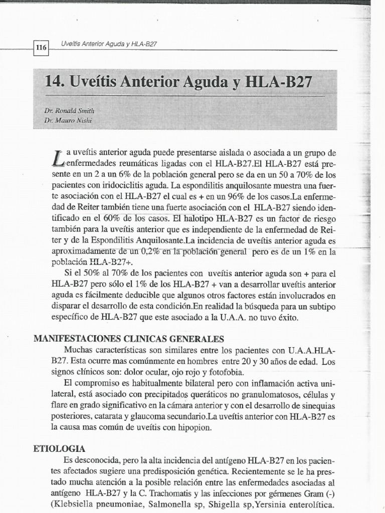 Cap 14 Uveitis Anterior Aguda - Uveitis Belfort Couto | PDF