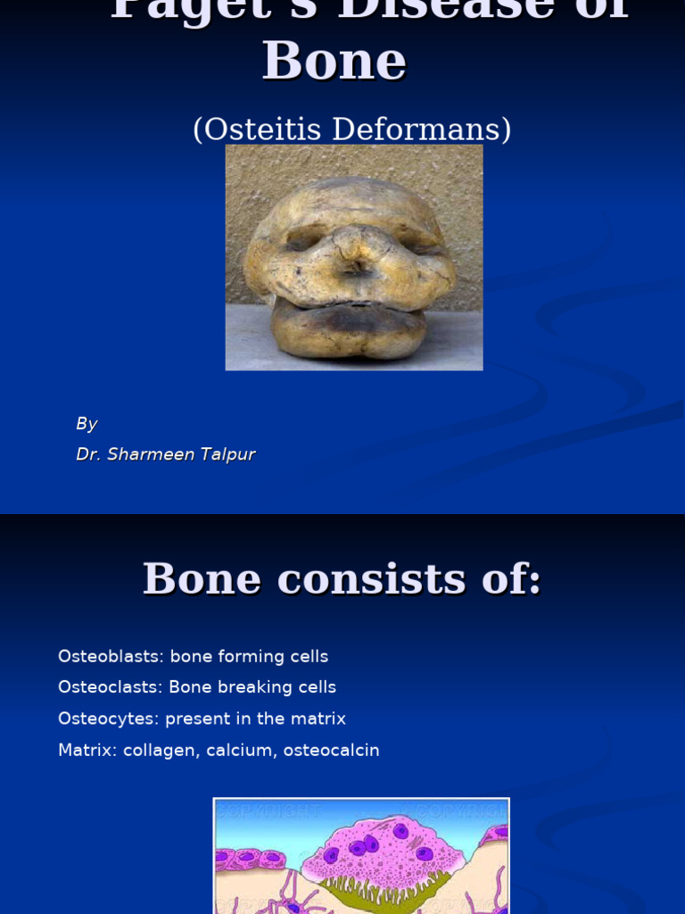 Pagets Disease of Bone | PDF
