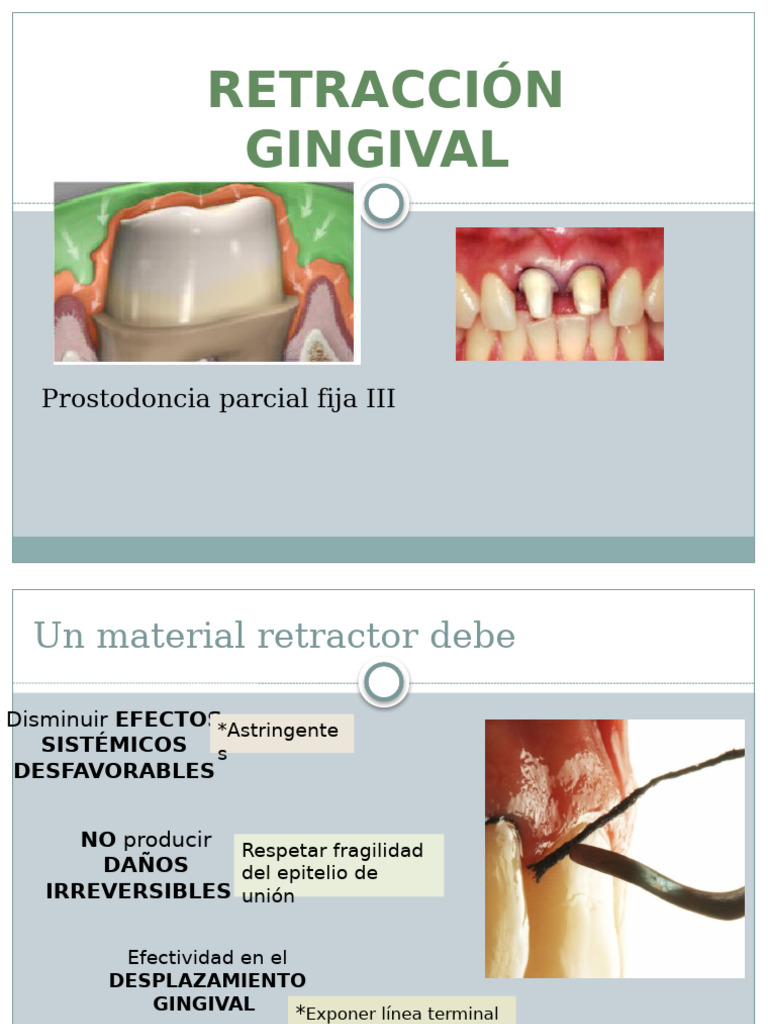 Retraccion Gingival | PDF