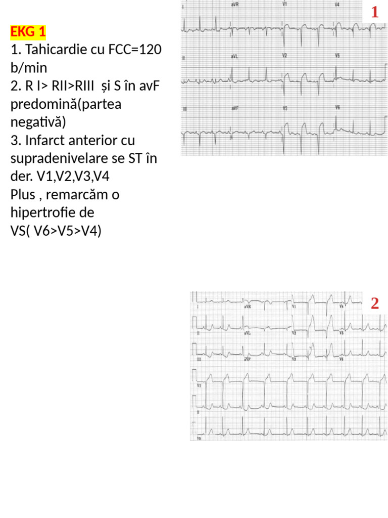 Ekg | PDF