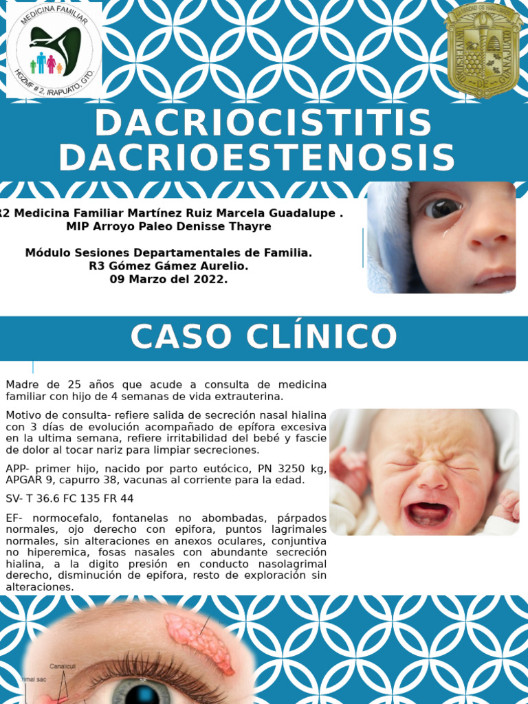 Dacriocistitis Dacrioestenosis | PDF