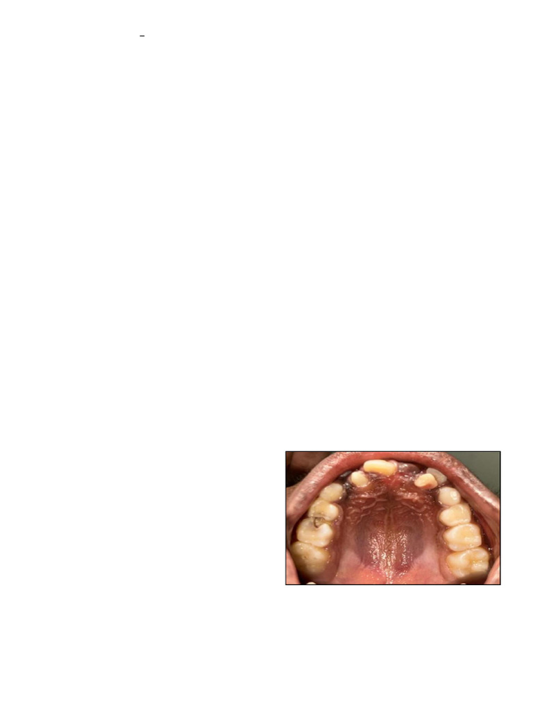 Management of Dens in Dente in Mesiodens (A Rare: Case Report) | PDF ...