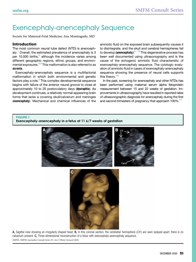 16 SMFM Exencephaly-Anencephaly Sequence 2020 | PDF