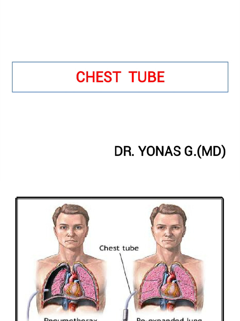 2. CHEST TUBE(1) | PDF