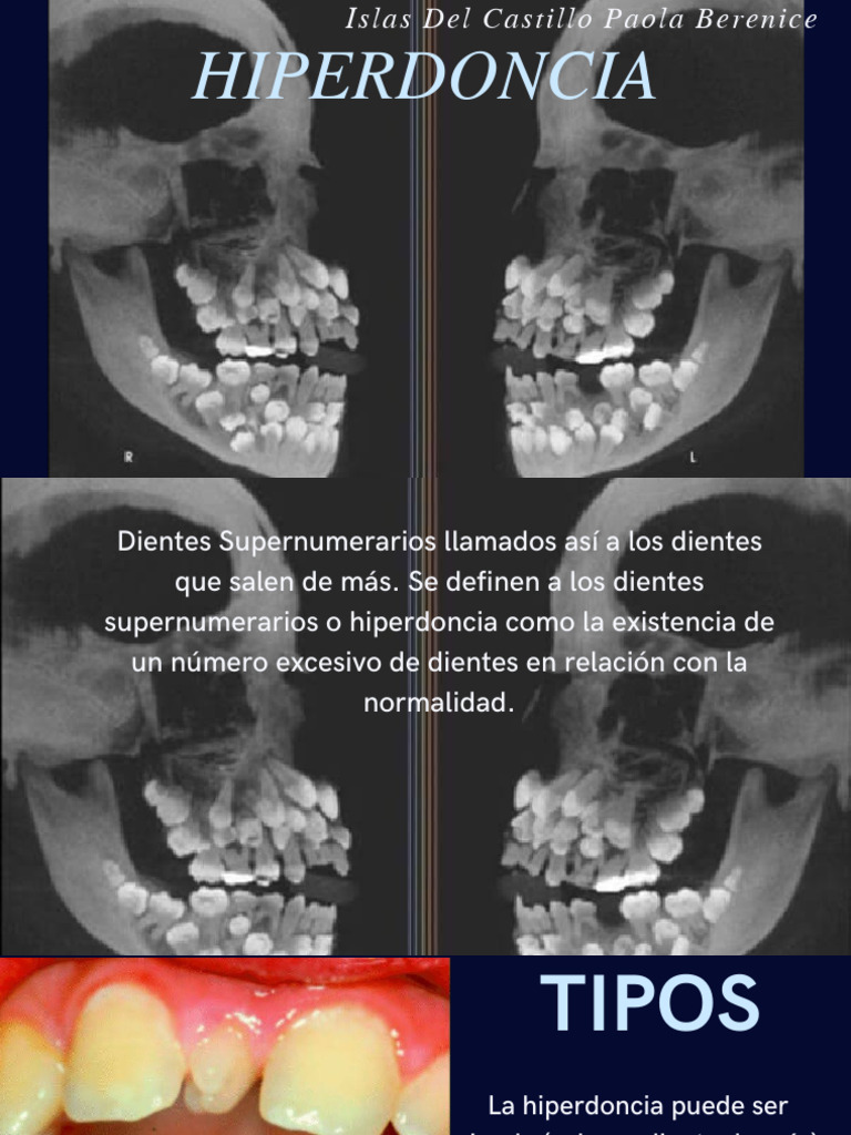 Hiperdoncia | PDF