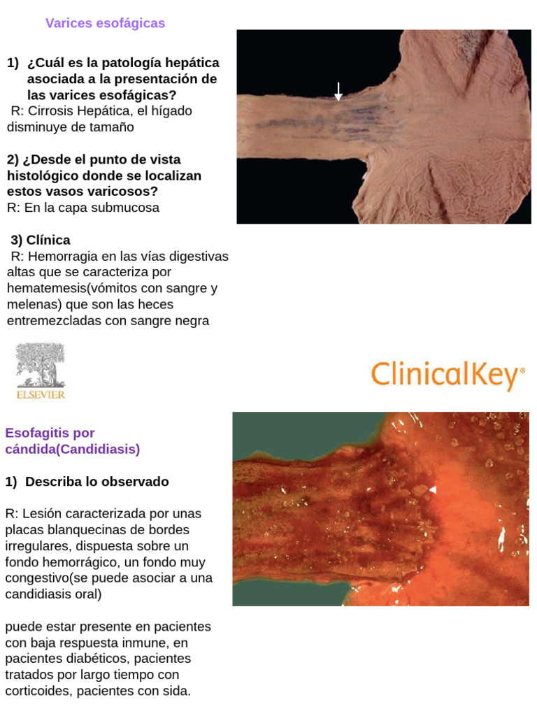 Varices esofágicas y patologías gástricas | PDF | Estómago | Esófago