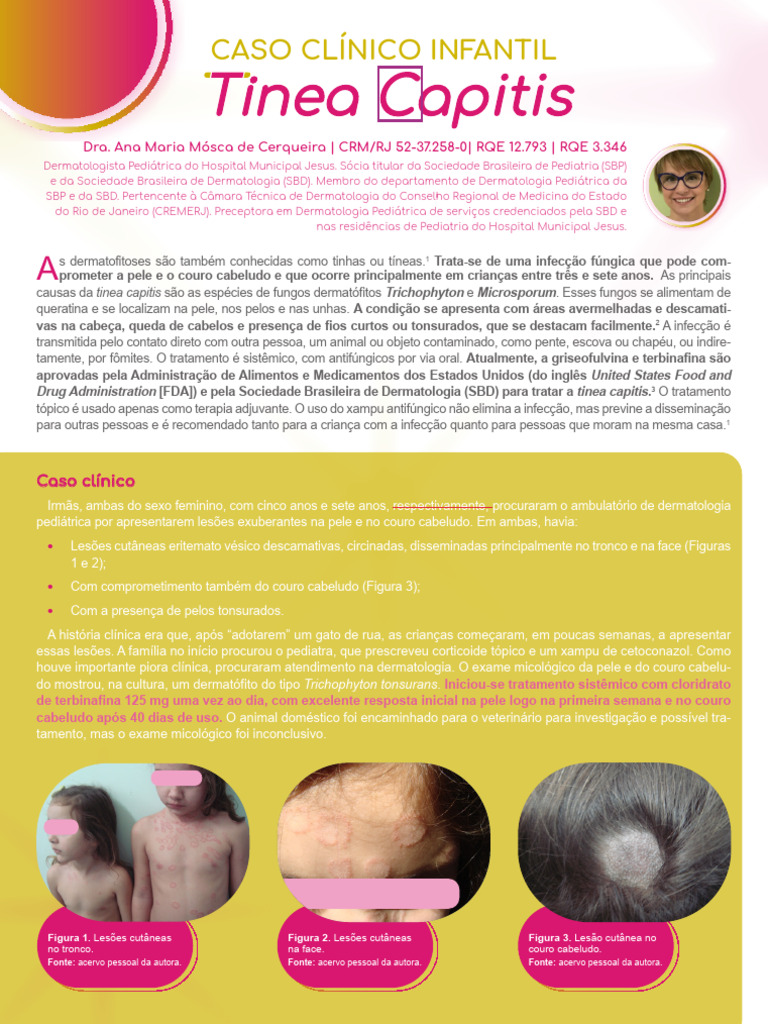Caso Clínico - Tinea Capitis - 2 - 9 - Ajus Lab+edit | PDF
