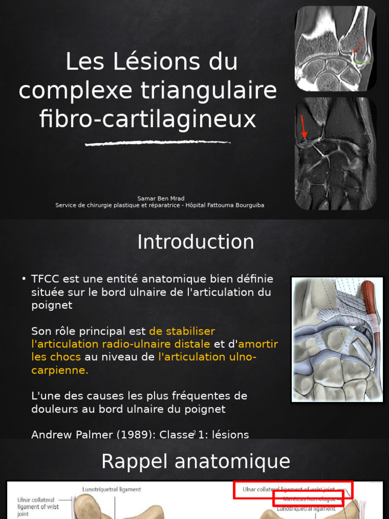 Lésions Du TFCC | PDF