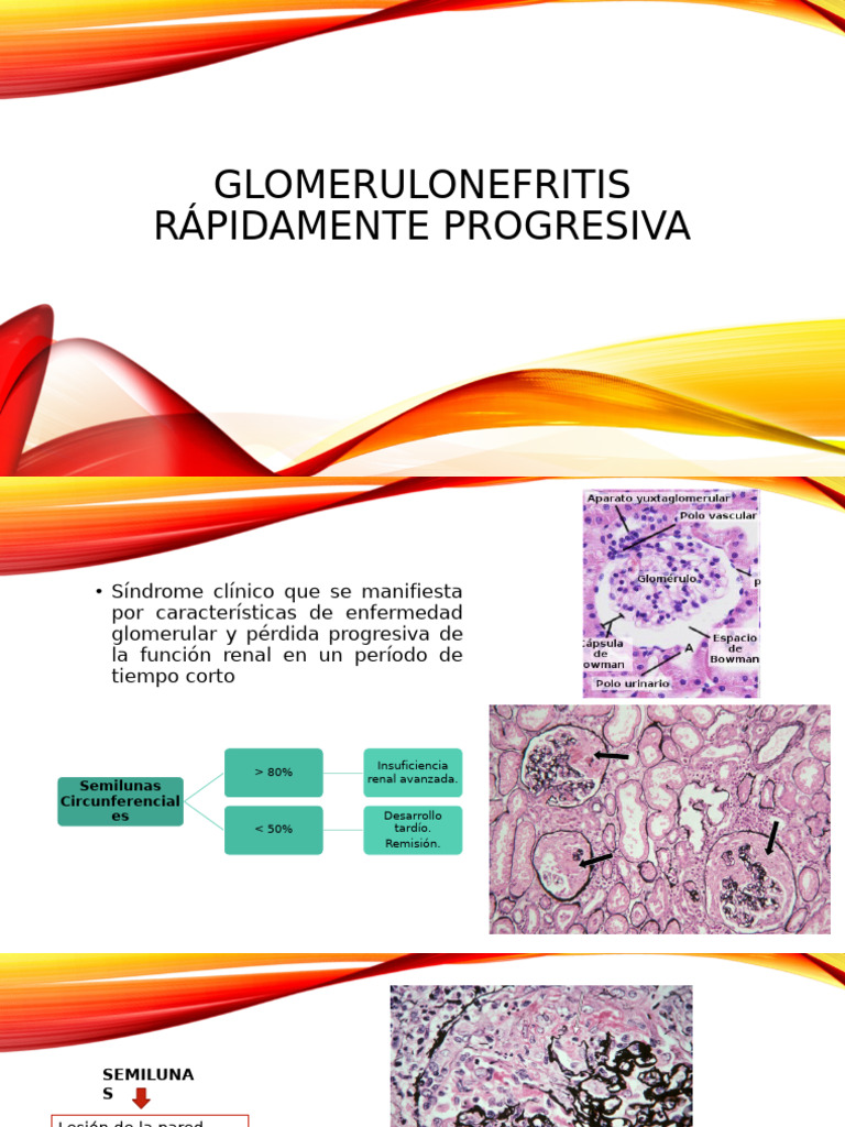 Glomerulonefritis Rápidamente Progresiva | PDF