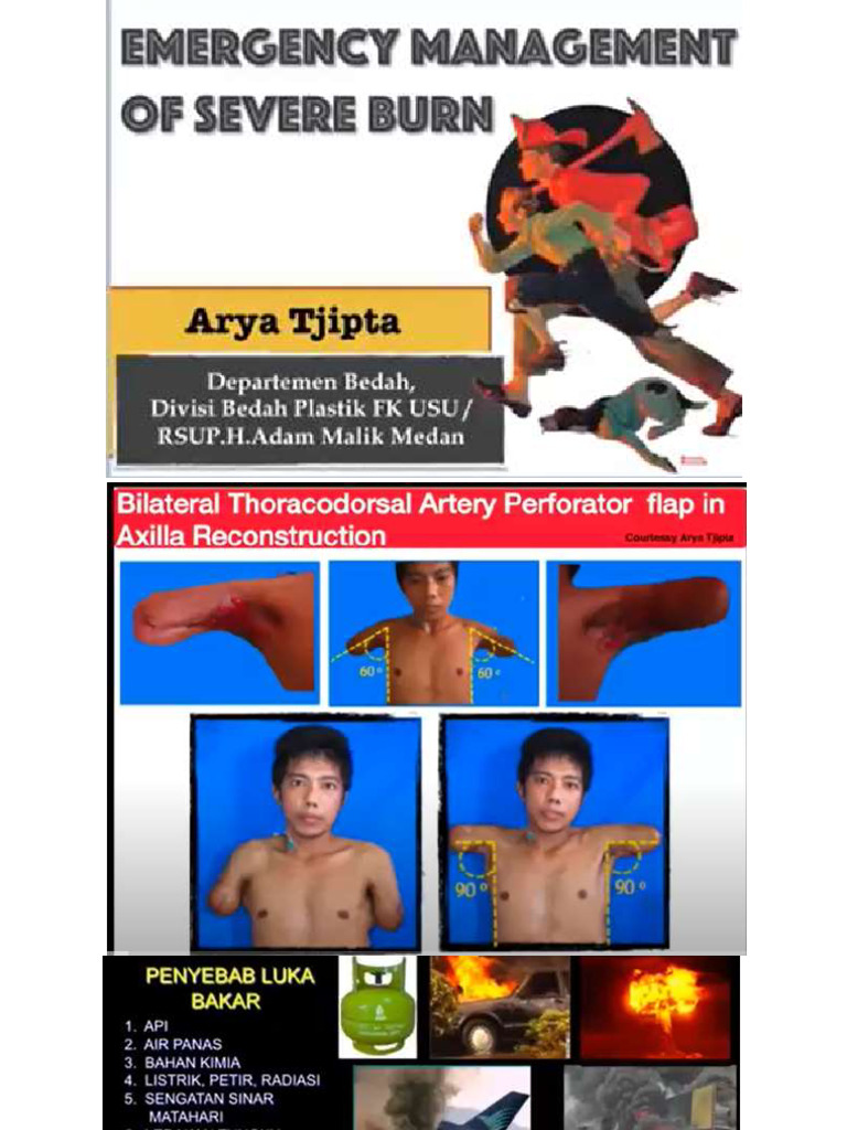 EM2-K1-3 BP Luka Bakar | PDF