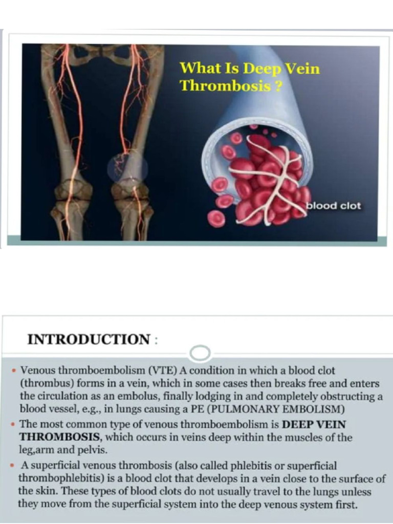 DVT | PDF