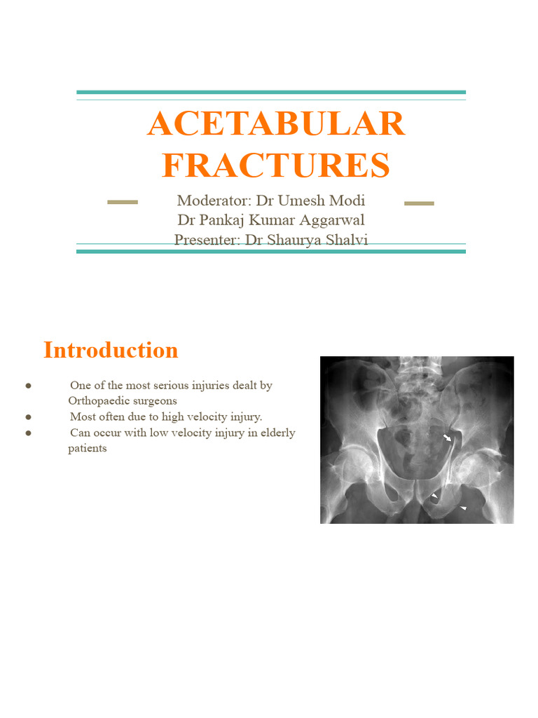 Acetabular Fractures Concepts | PDF