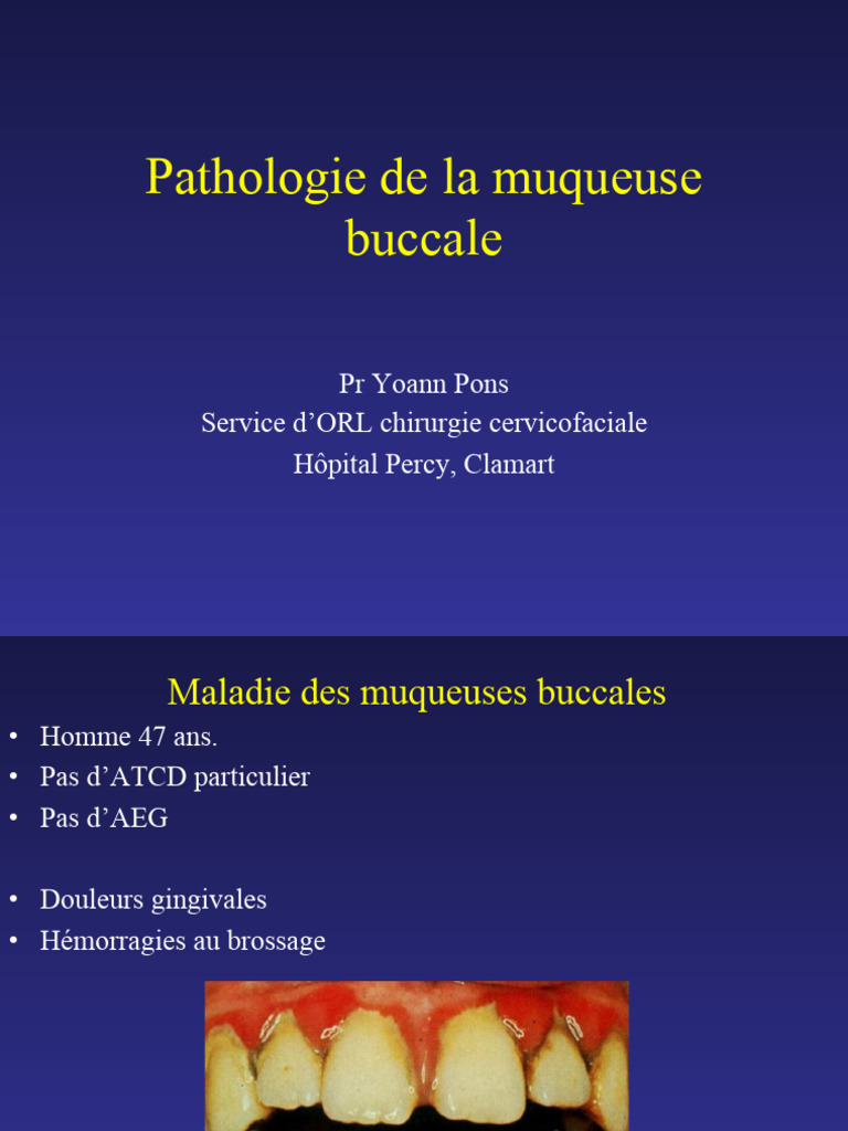 Yoann Pons - Pathologie-Cavite-Buccale-Med-G (1) PDF | PDF