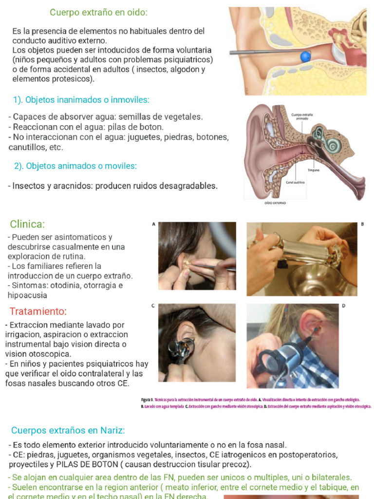 Cuerpo extraño-OTORRINO | PDF