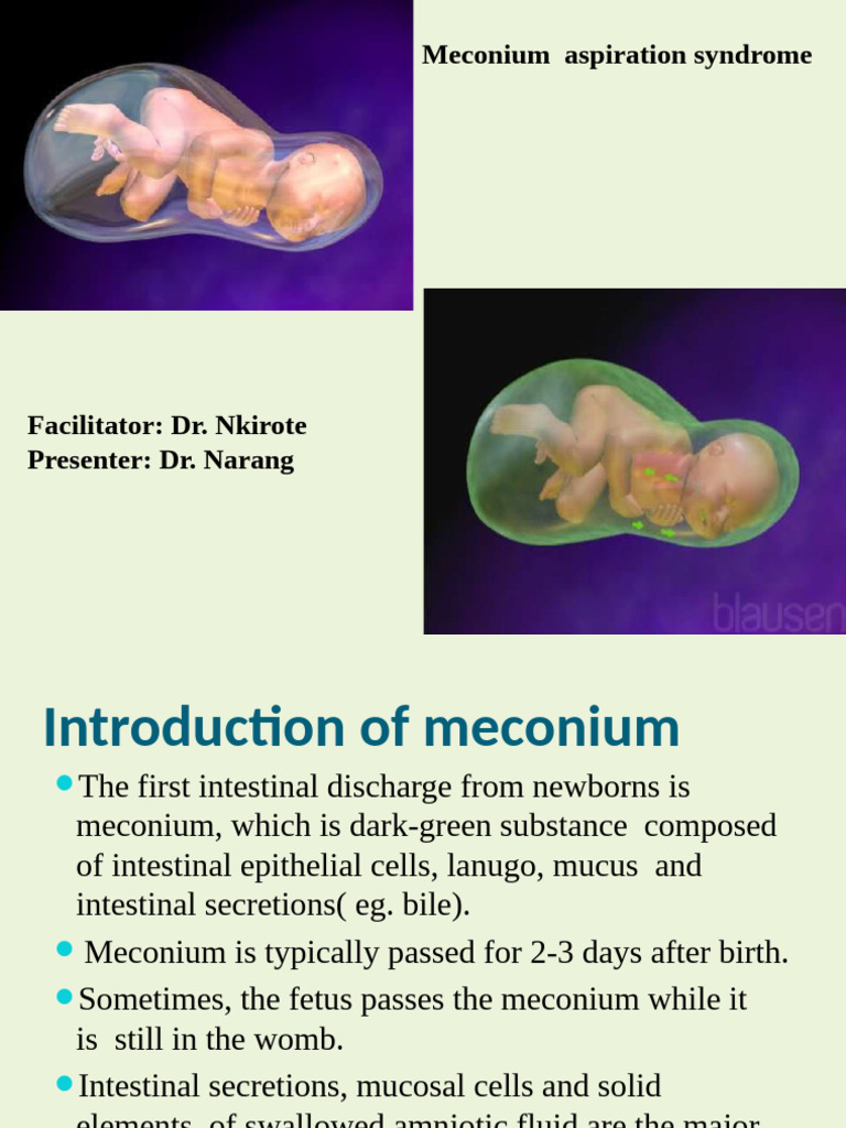 Meconium Aspiration Syndrome | PDF