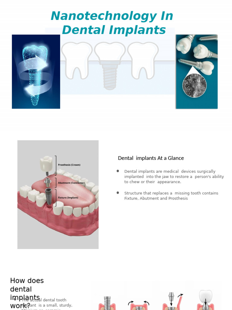 Dental Implant | PDF