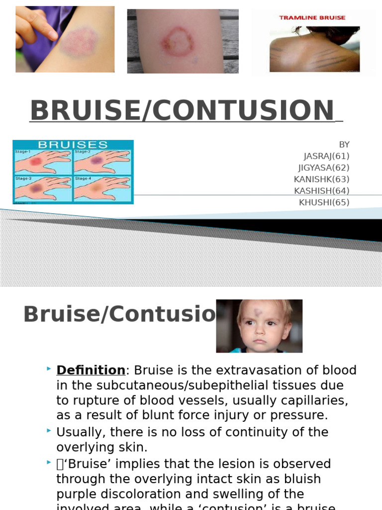 Bruise 2 | PDF
