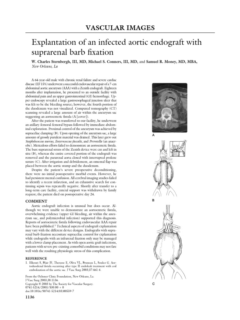 Explantation-of-an-infected-aortic-endograft-with- | PDF