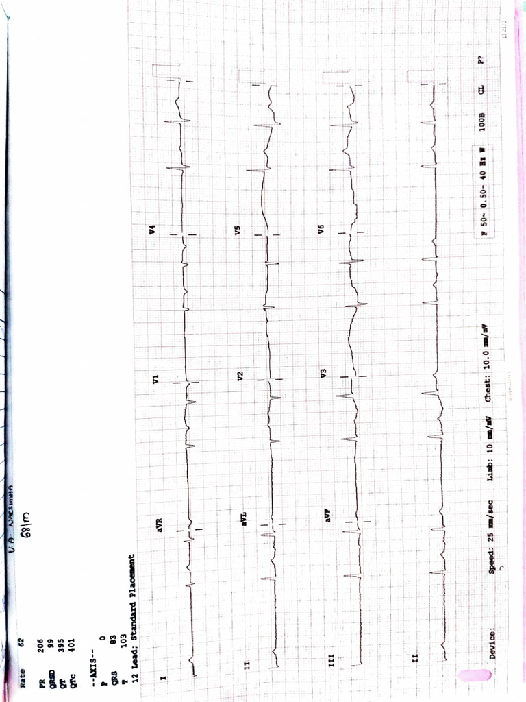 2nd degree type 1 block | PDF