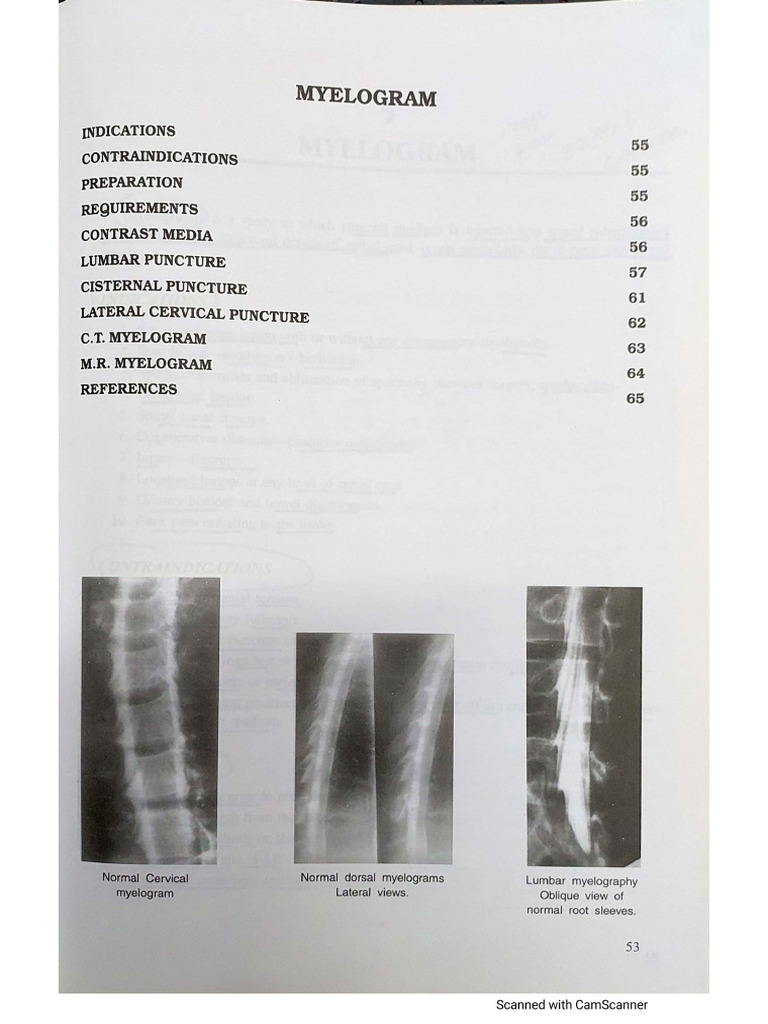 Myelography Bhushan | PDF
