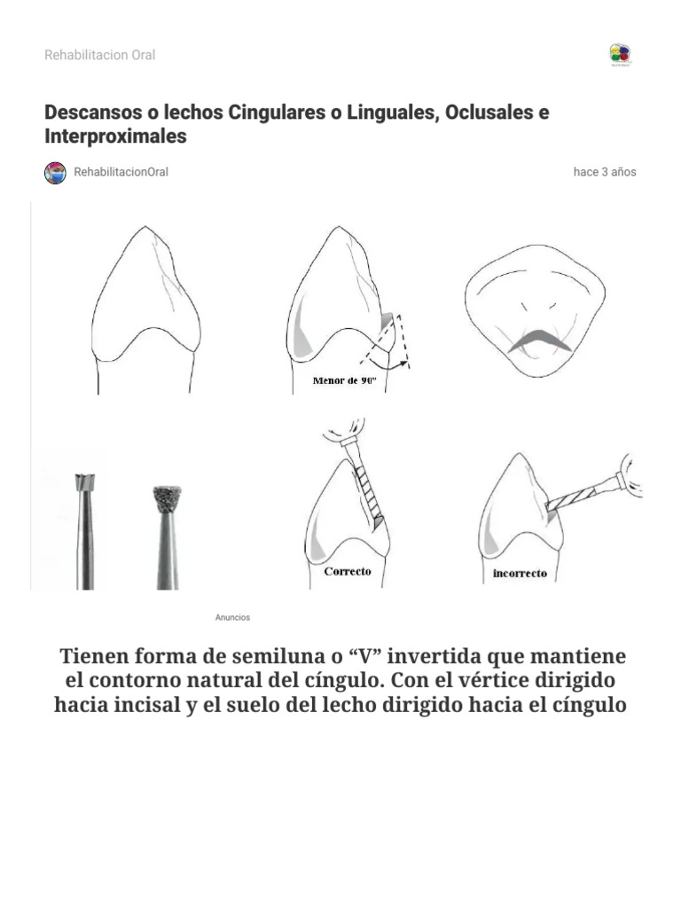 Descansos o Lechos Cingulares o Linguales, Oclusales e Interproximales ...