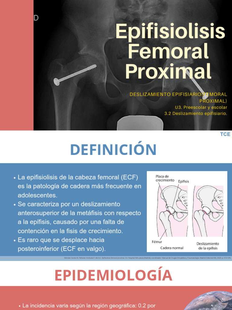 Epifisiolisis Femoral Proximal | PDF