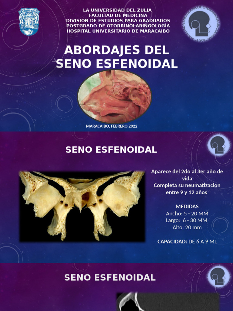Abordaje de Seno Esfenoidal | PDF