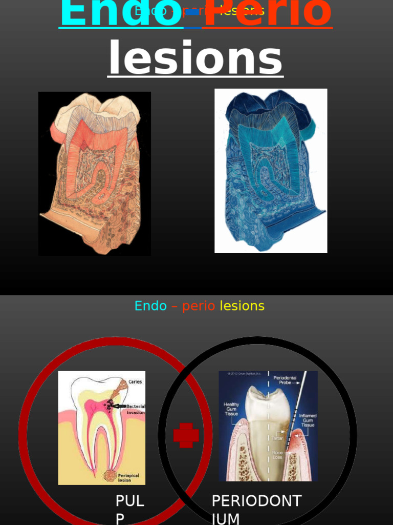 43 Endo-Perio Lesions Seminar | PDF