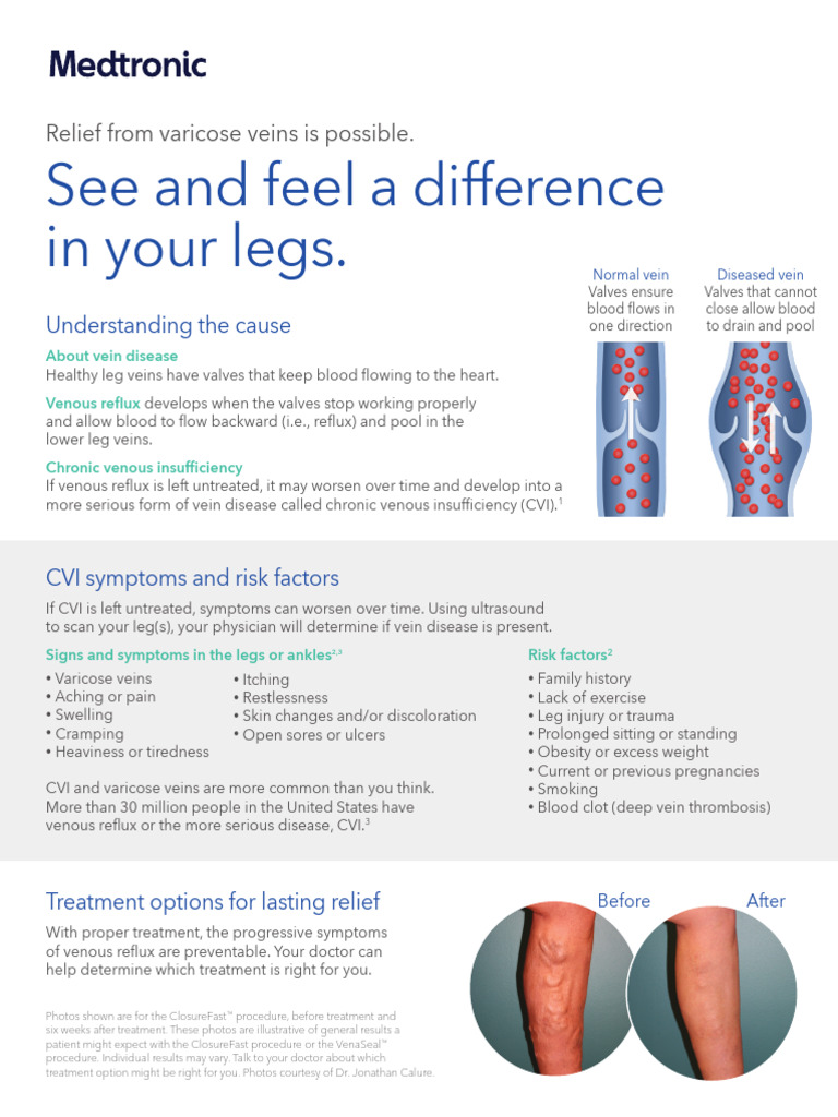 Cvi Two Treatment Choice Guide | PDF