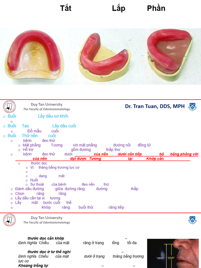 Complete Denture Summary | PDF