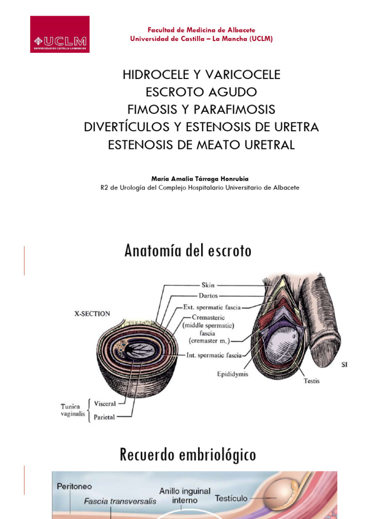 Hidrocele, Varicocele. Escroto Agudo. Fimosis, Parafimosis. Uretra | PDF