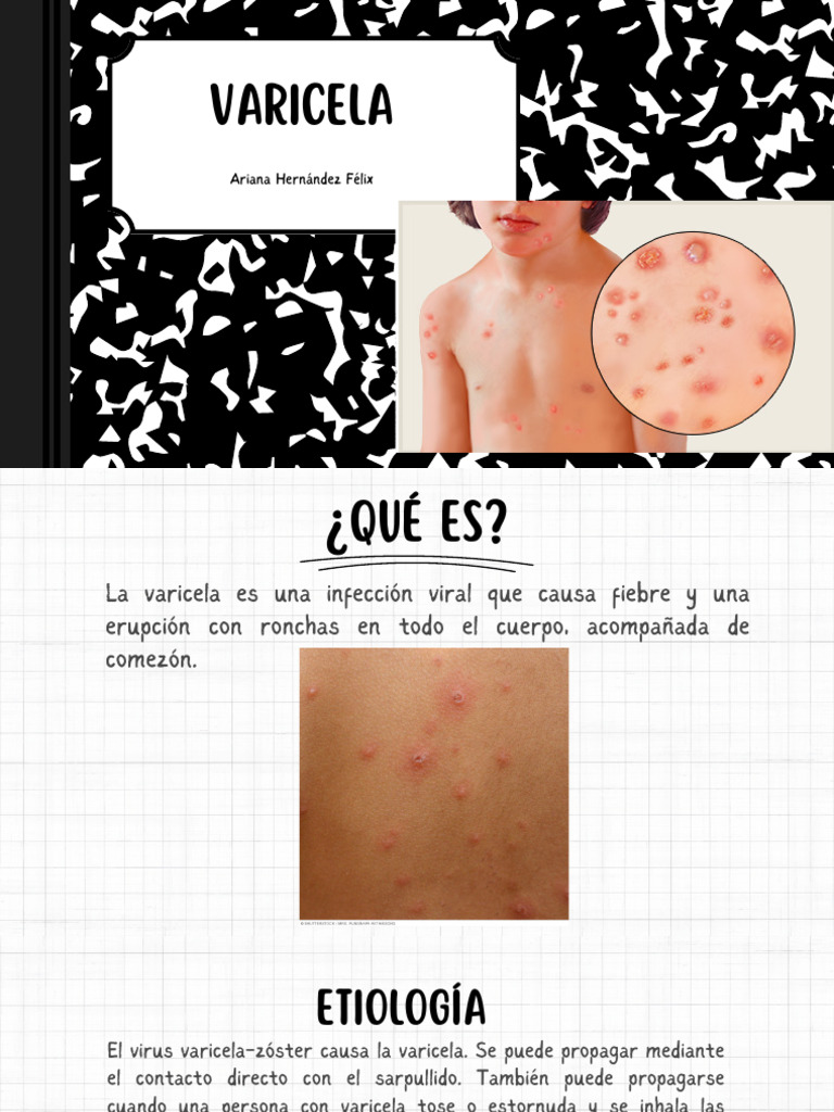 varicela | PDF