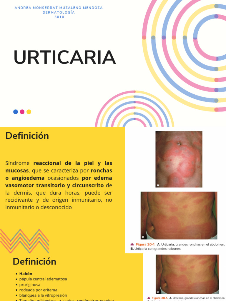 Urticaria PDF | PDF