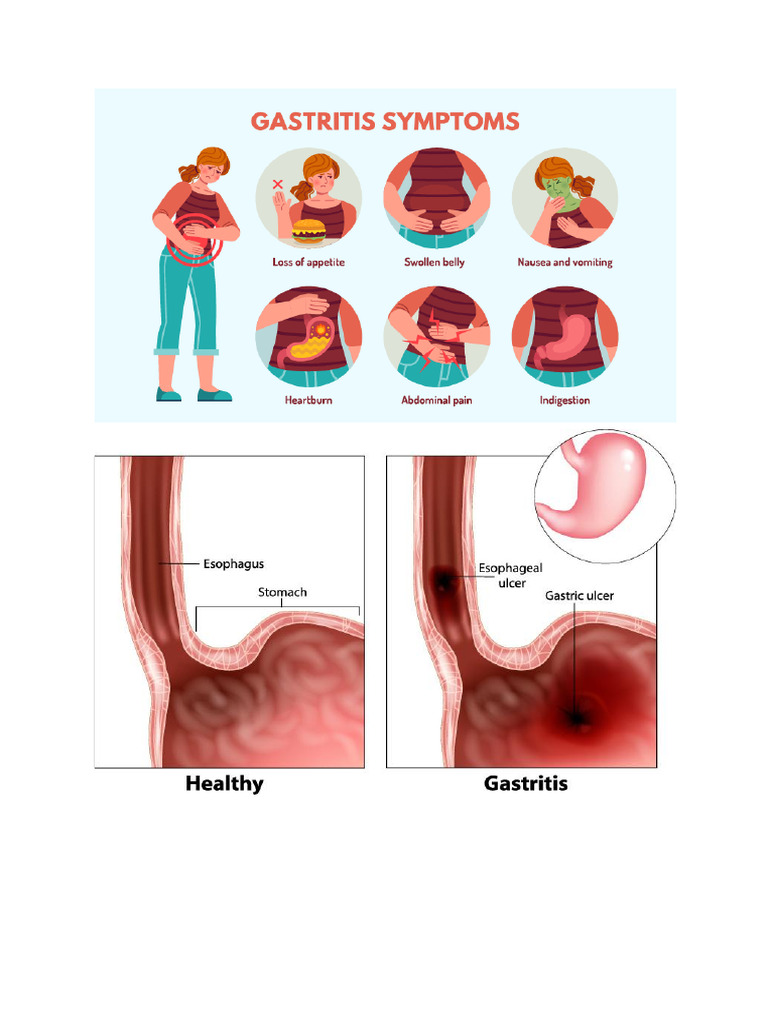 GASTRITIS | PDF