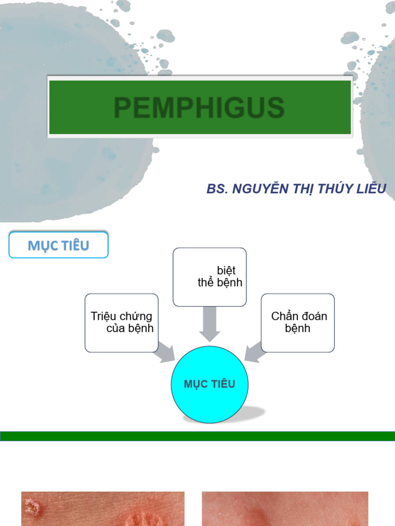 4. Bệnh Da Bóng Nước (Pemphigus) | PDF