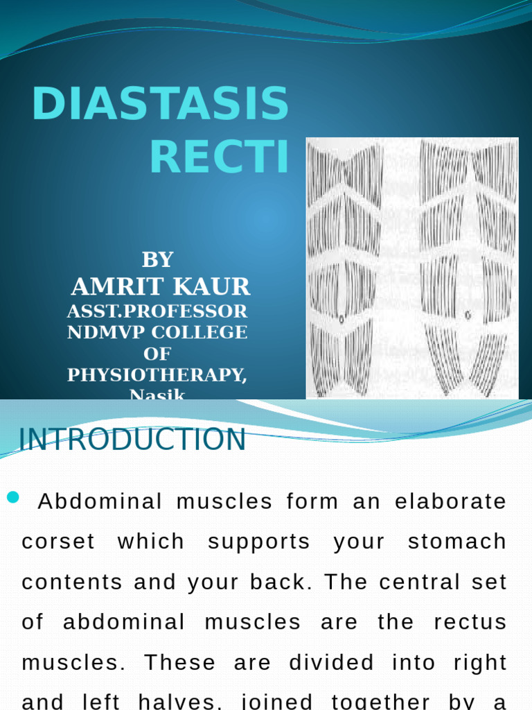 Diastasis Recti | PDF