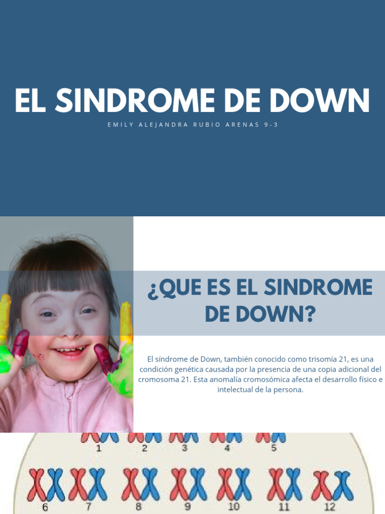 Sindrome de Down | PDF