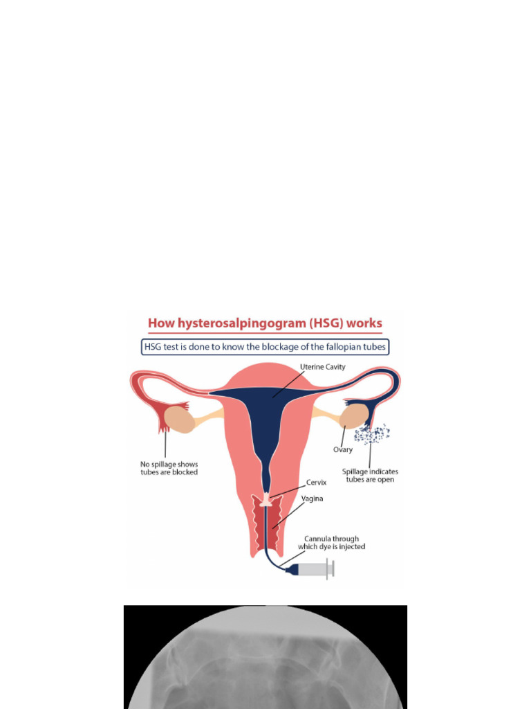 Hysterosalpingography: Dr. Sanjay S C | PDF
